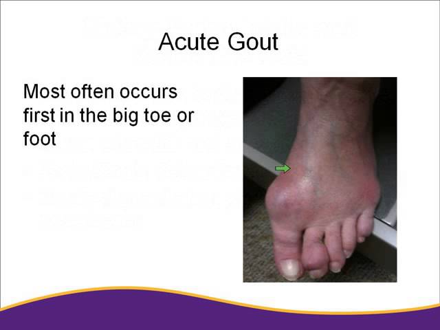 The Link between Gout Heart Disease – Breast Cancer Daily